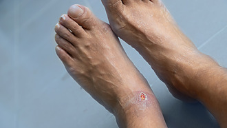 Ulcère de la jambe | symptômes, description et traitement