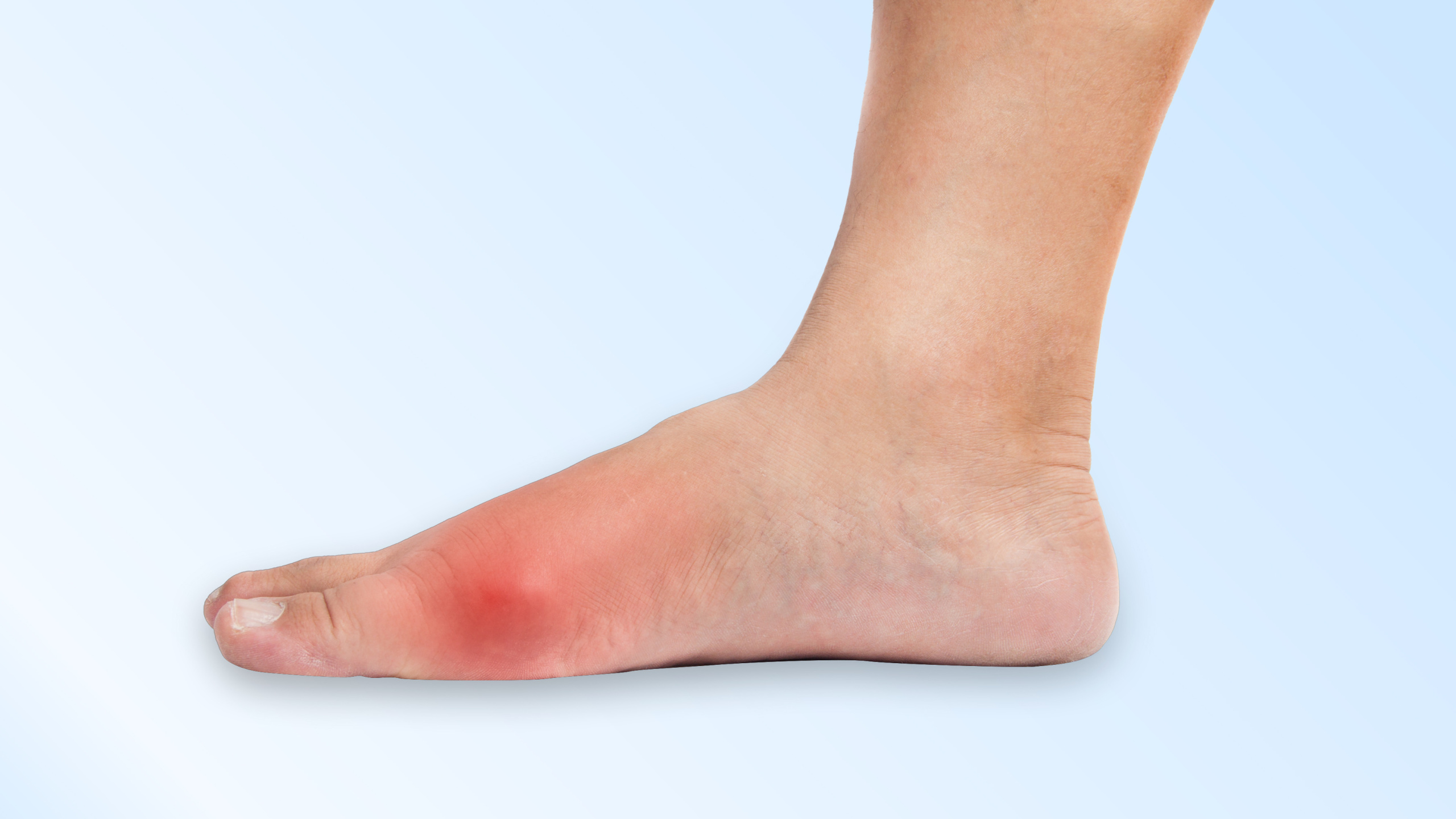 Goutte - description, traitement et recommandations des médecins